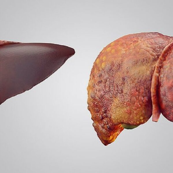 Healthy And Unhealthy Liver Unhealthy Liver: Over 3,926 Royalty Free